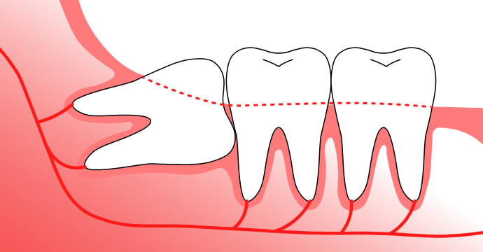 Inverted Impacted Wisdom Tooth