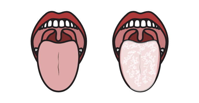 ORAL THRUSH: SYMPTOMS, CAUSES, AND TREATMENTS – Fairywill